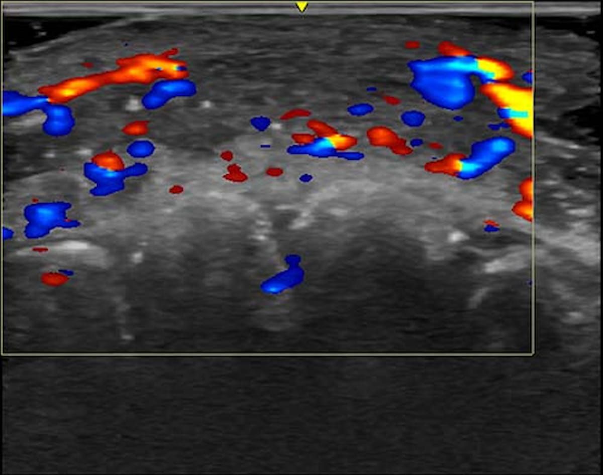 RSNA: Ultrasound Study Reveals Vascular Complications Associated with ...