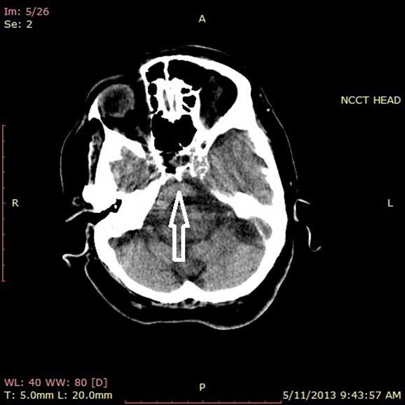 Basilar Artery Ectasia | Diagnostic Imaging