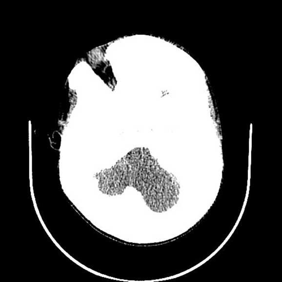 Fibrous Dysplasia of the Skull (Leontiasis Ossea) | Diagnostic Imaging