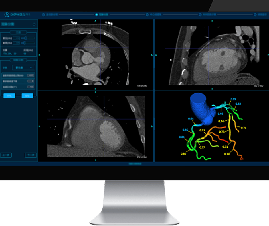 Could an Emerging Deep Learning Modality Enhance CCTA Assessment of ...
