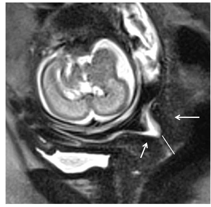 MRI May Predict Preterm Birth