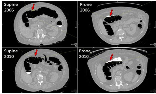 CT Colonography Algorithm Helps Radiologists Recognize Polyps