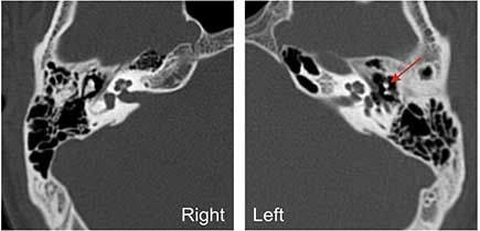 Post-traumatic Ossicular Dislocation