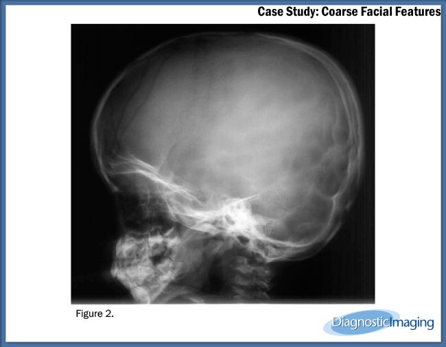 Coarse Facial Features, Short Stature, Spinal Deformity
