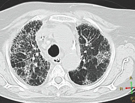Usual Interstitial Pneumonia