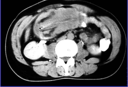 Image IQ: Colocolic Intussusception