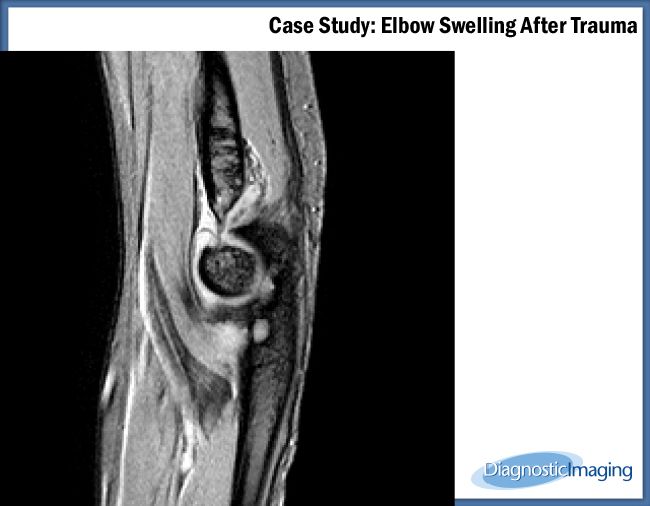 Elbow Swelling After Trauma