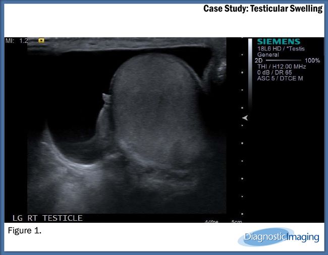 Testicular Swelling