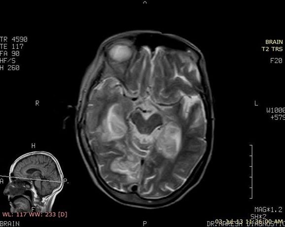 Herpes Simplex Encephalitis