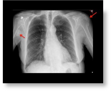 Image IQ: 74 y/o; Lump over right axillary region | Diagnostic Imaging