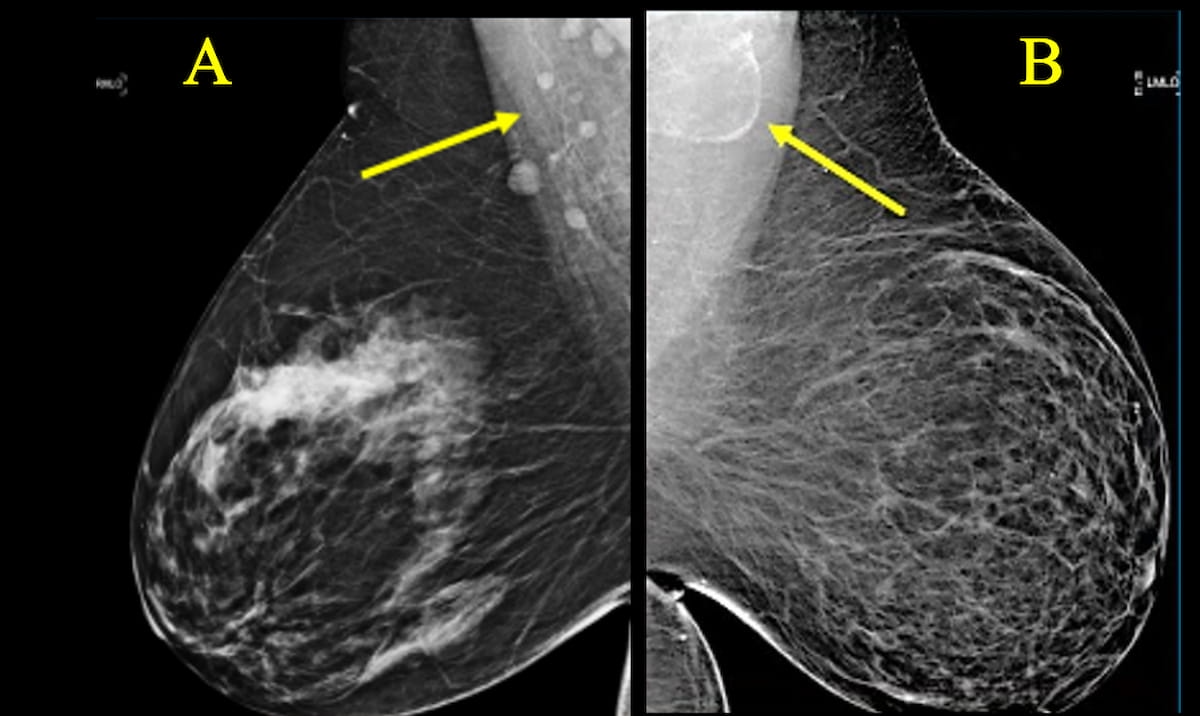 Mammography Study Shows Link Between Enlarged Axillary Lymph Nodes and ... Mammography Study Shows Link Between Enlarged Axillary Lymph Nodes and ...