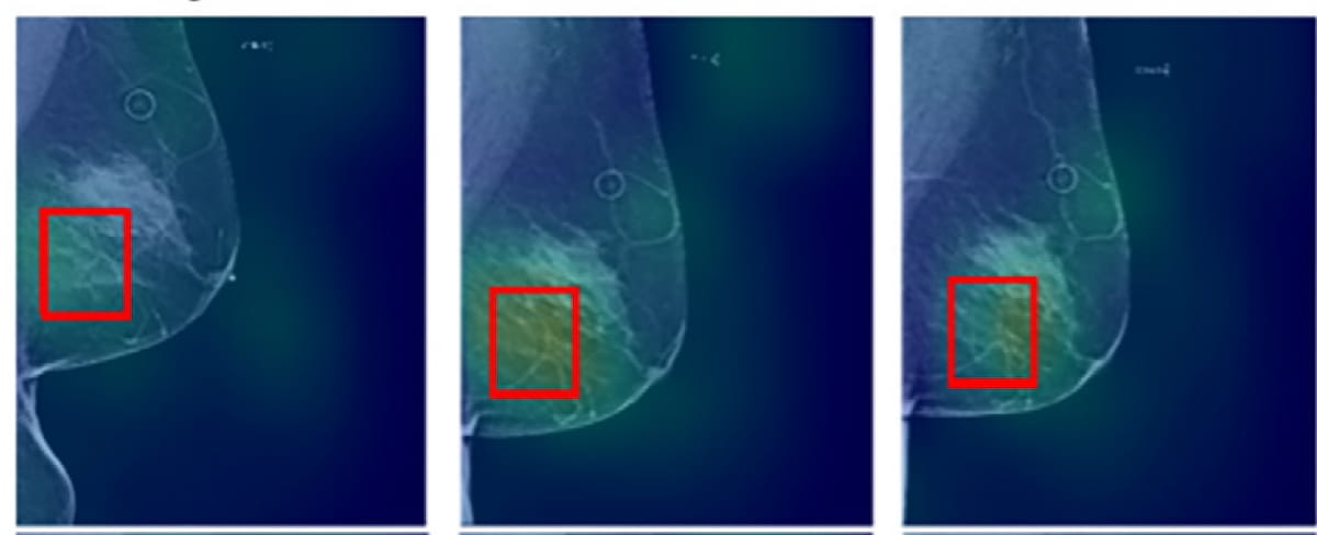 Mammography Study: Deep Learning Emphasis on Bilateral Dissimilarity ... Mammography Study: Deep Learning Emphasis on Bilateral Dissimilarity ...