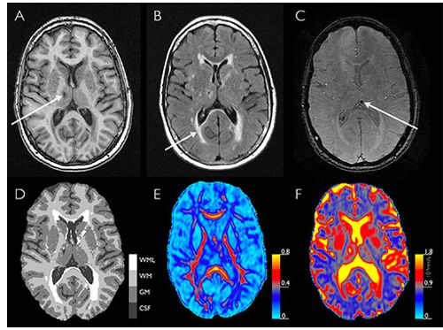 Imaging Finds Link Between Brain, Heart Disease