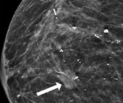 What a New Study Reveals About Radiographers and Mammography Assessment
