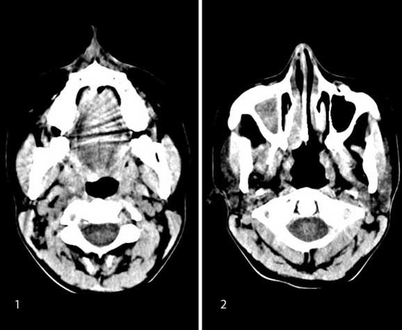 Test Antrochoanal Polyp Case Study | Diagnostic Imaging