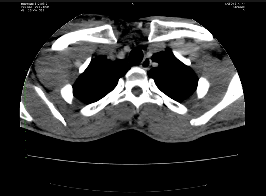 Image Iq Quiz Video Patient Presents With Enlarging Neck And Shoulder Region