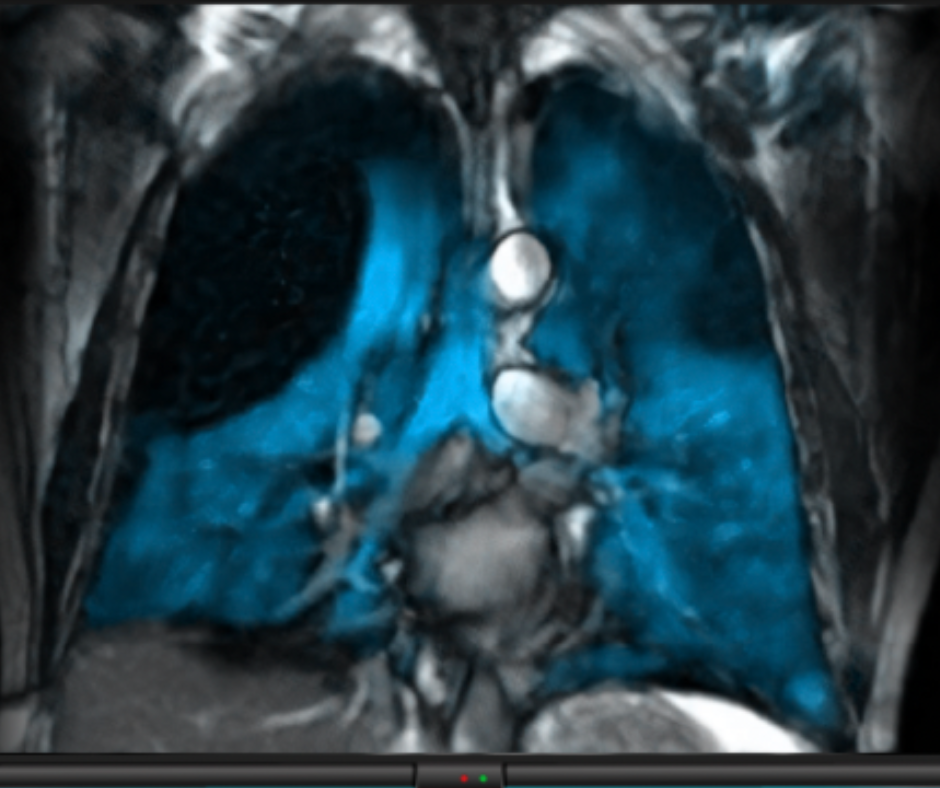 First Hyperpolarized MRI Contrast Agent Gets FDA Approval