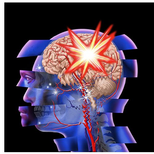 DTI May Predict One-Year Outcome in Mild Traumatic Brain Injury