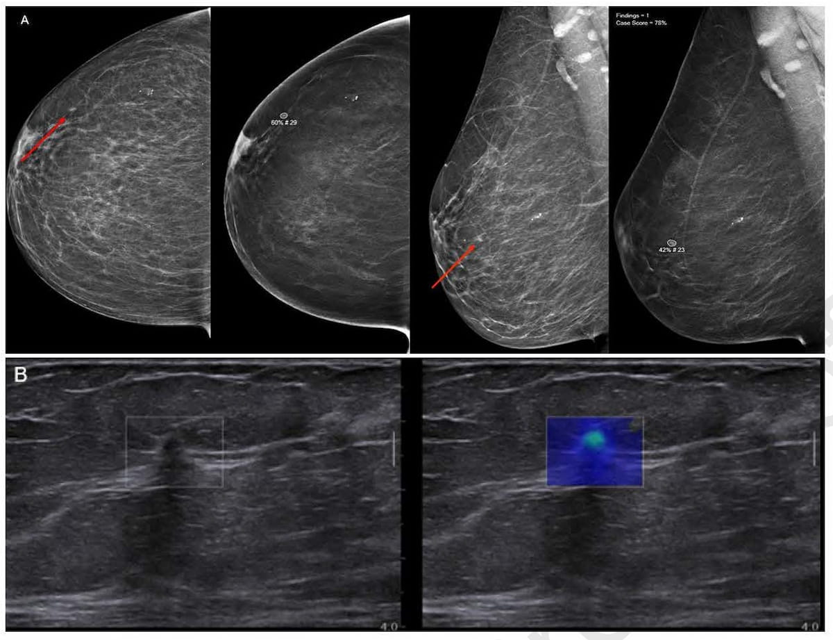 Large Mammography Study Shows AI-Aided DBT Bolsters Cancer Detection ...