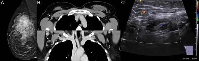 MRI/CT Imaging for Axillary Lymph Nodes: What a New Breast Cancer Study ...