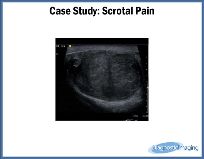 Scrotal Pain