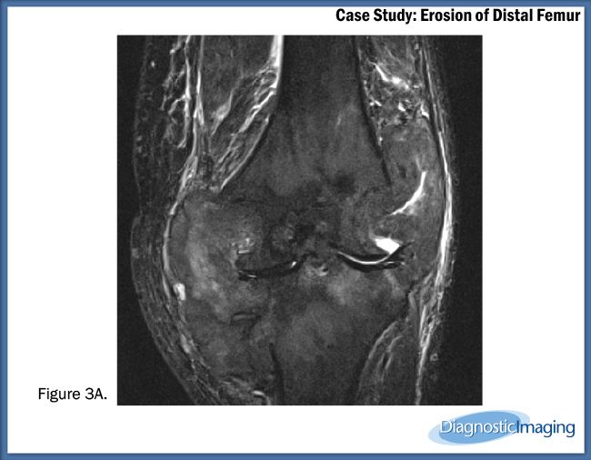 Erosion of Distal Femur, Loss of Collateral Ligament