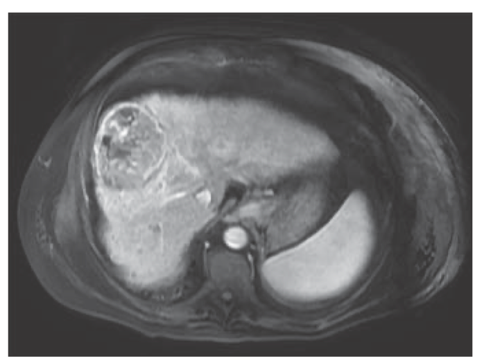 Discrepancy Rates and Errors a Bigger Problem with Body MRI Than Realized