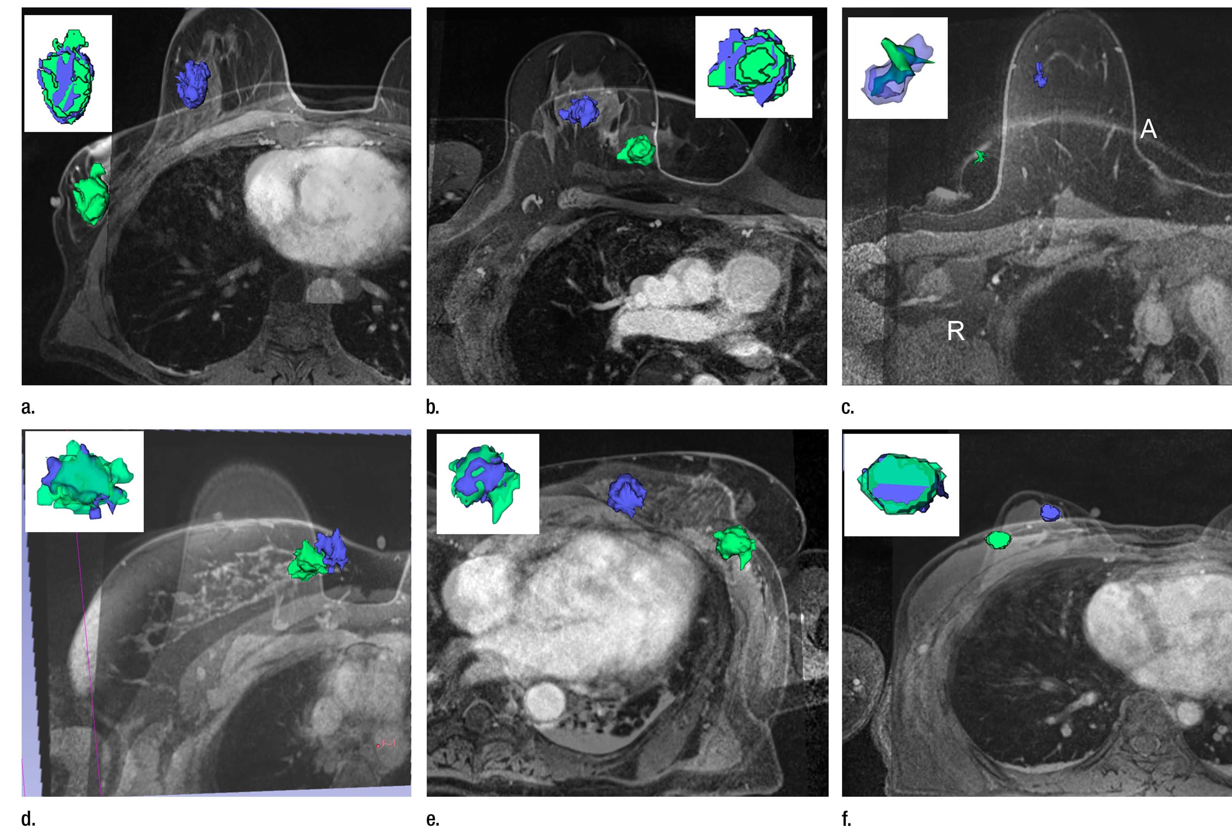 MRI Position Affects Evaluation of Residual Breast Cancer