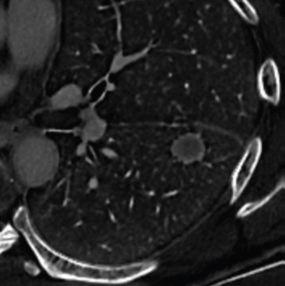 Can Dual-Energy CT Have an Impact in Differentiating Primary Lung ...