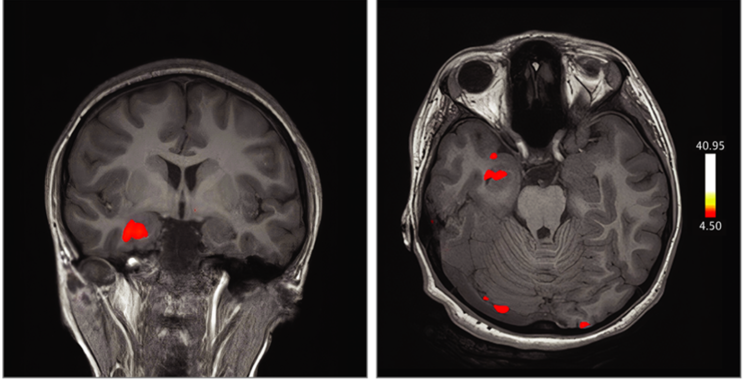fMRI Identifies Smell and Taste Malfunction in COVID-19 Patients ...