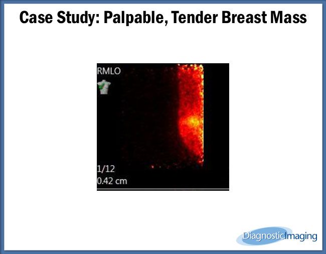 Palpable, Tender Breast Mass