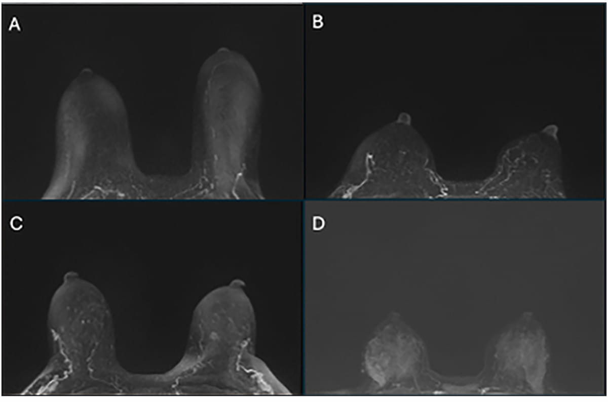 Breast MRI Study Suggests Black Women Are 31 Percent More Likely to ...