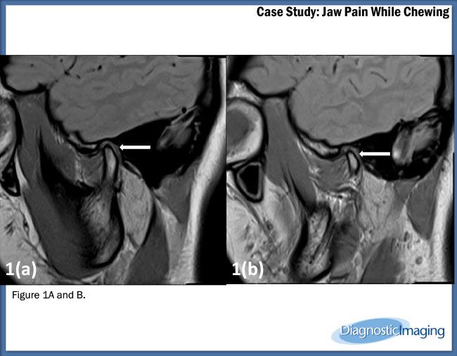 Jaw Pain While Chewing
