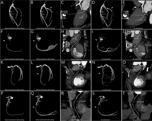 Deep Learning Improves CT Guidance for Revascularization of Coronary ...
