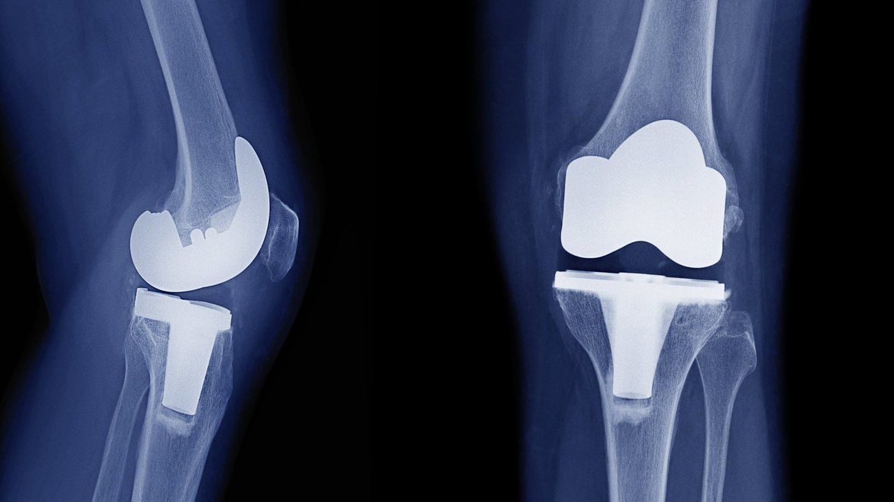 AI Model a Step Forward in Predicting Total Knee Replacements ...