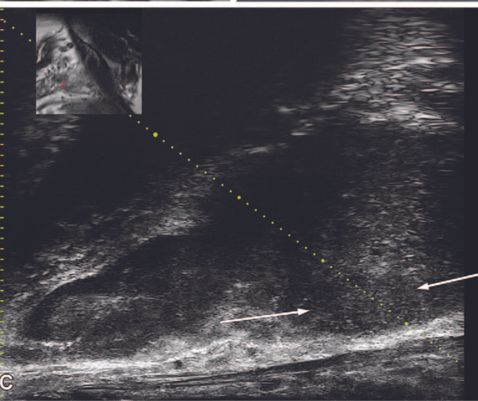 Is Micro-Ultrasound a Viable Option for Detecting Prostate Cancer?