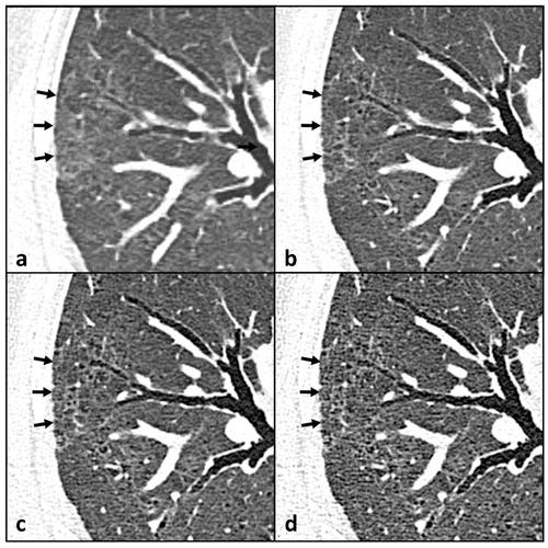 Study Shows Merits of Photon-Counting CT in Detecting Subtle Post-COVID ...