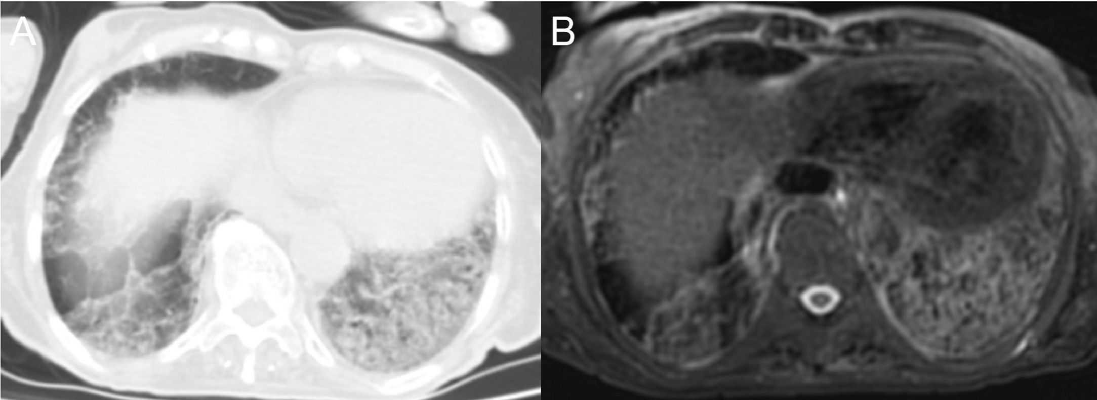Thoracic MRI Is Effective as Alternative to CT in Detecting COVID-19 ...