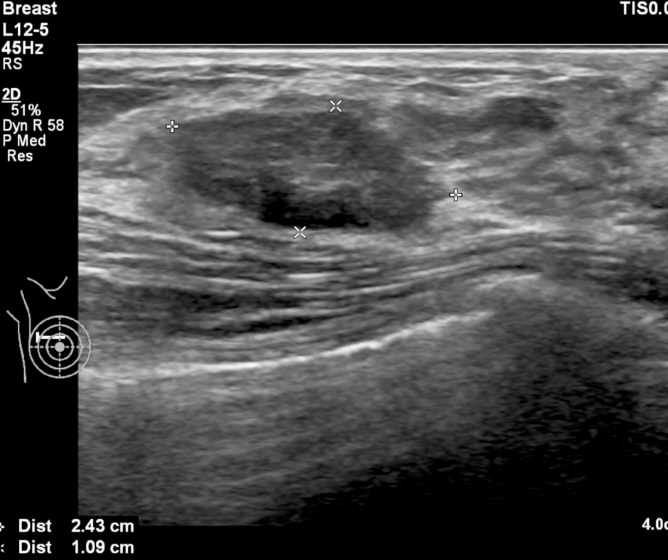 Automated Breast Ultrasound: Is it a Viable Second-Look Option for ...