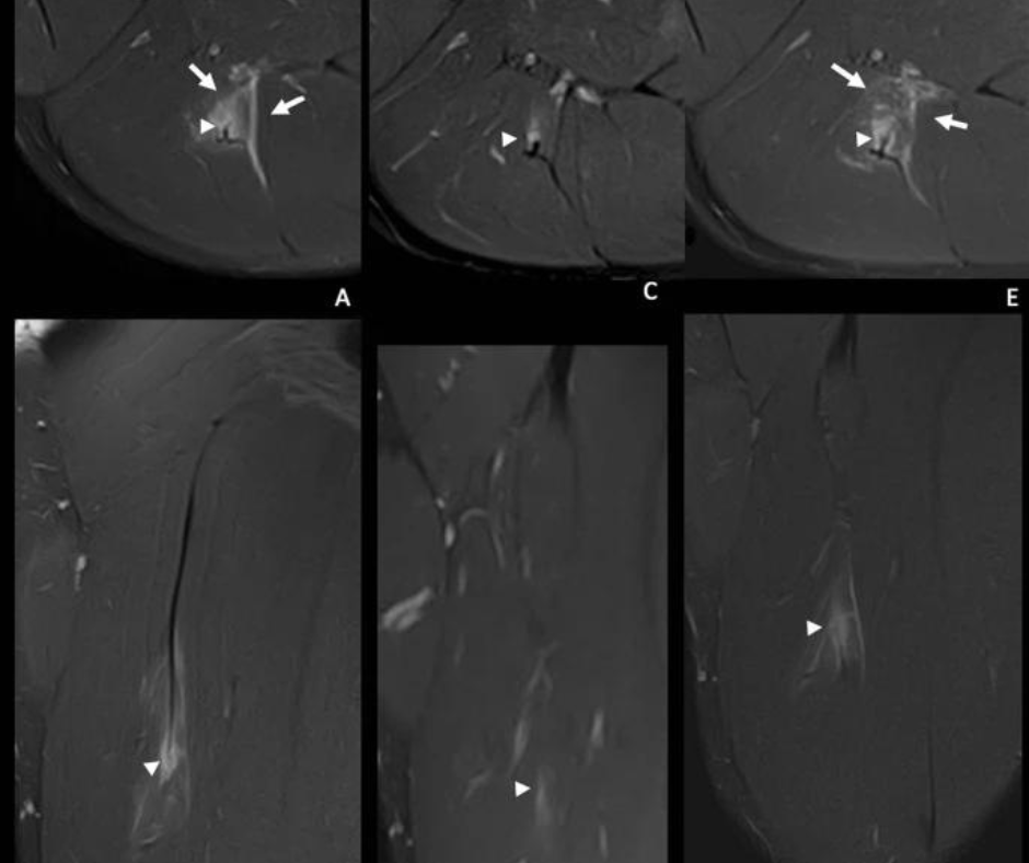 What a New Study Reveals About MRI and Predicting Muscle Injury ...