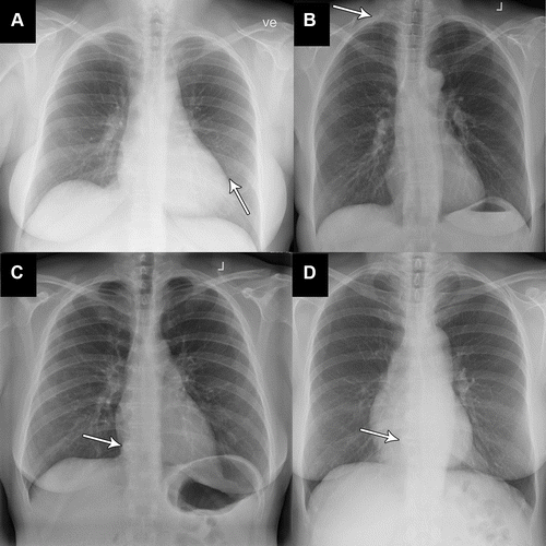 Autonomous Ai Shows Nearly 27 Percent Higher Sensitivity Than Radiology Reports For Abnormal