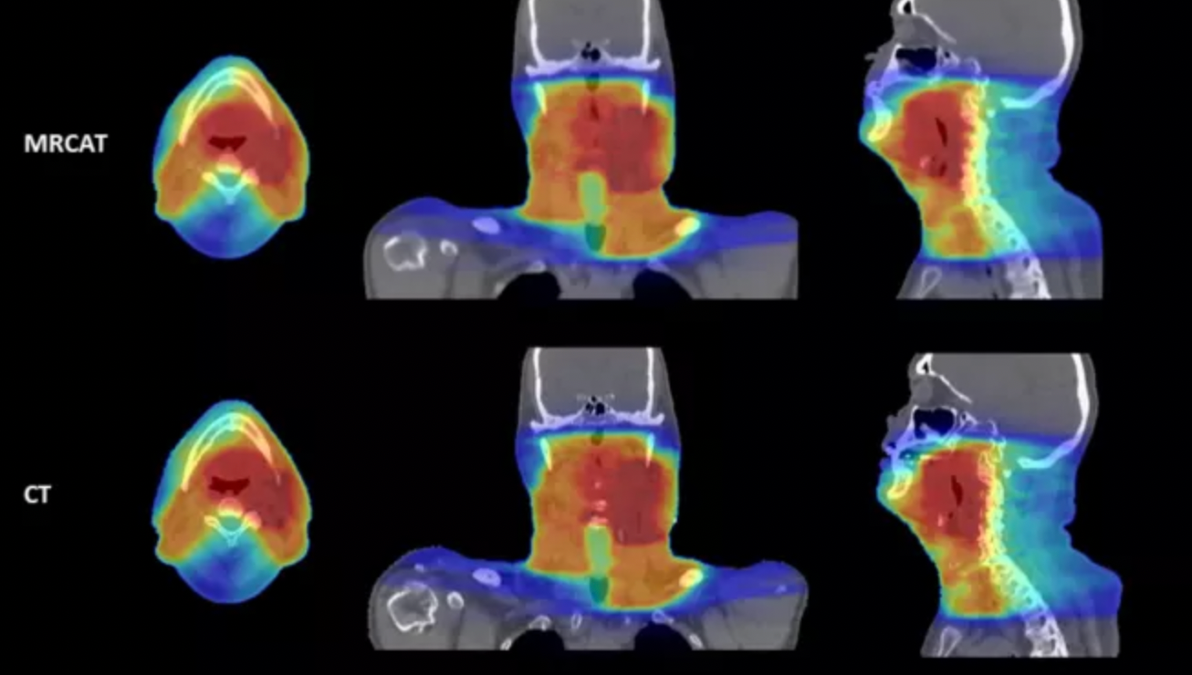 Philips Gets FDA Nod for MRI Head and Neck Radiotherapy Application