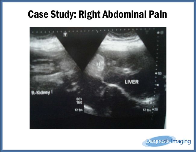 Right Abdominal Pain