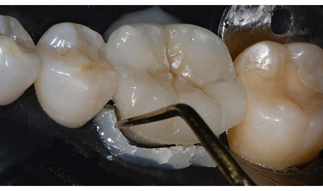 How to Simplify Cementation of a supragingival Lithium Disilicate Crown ...
