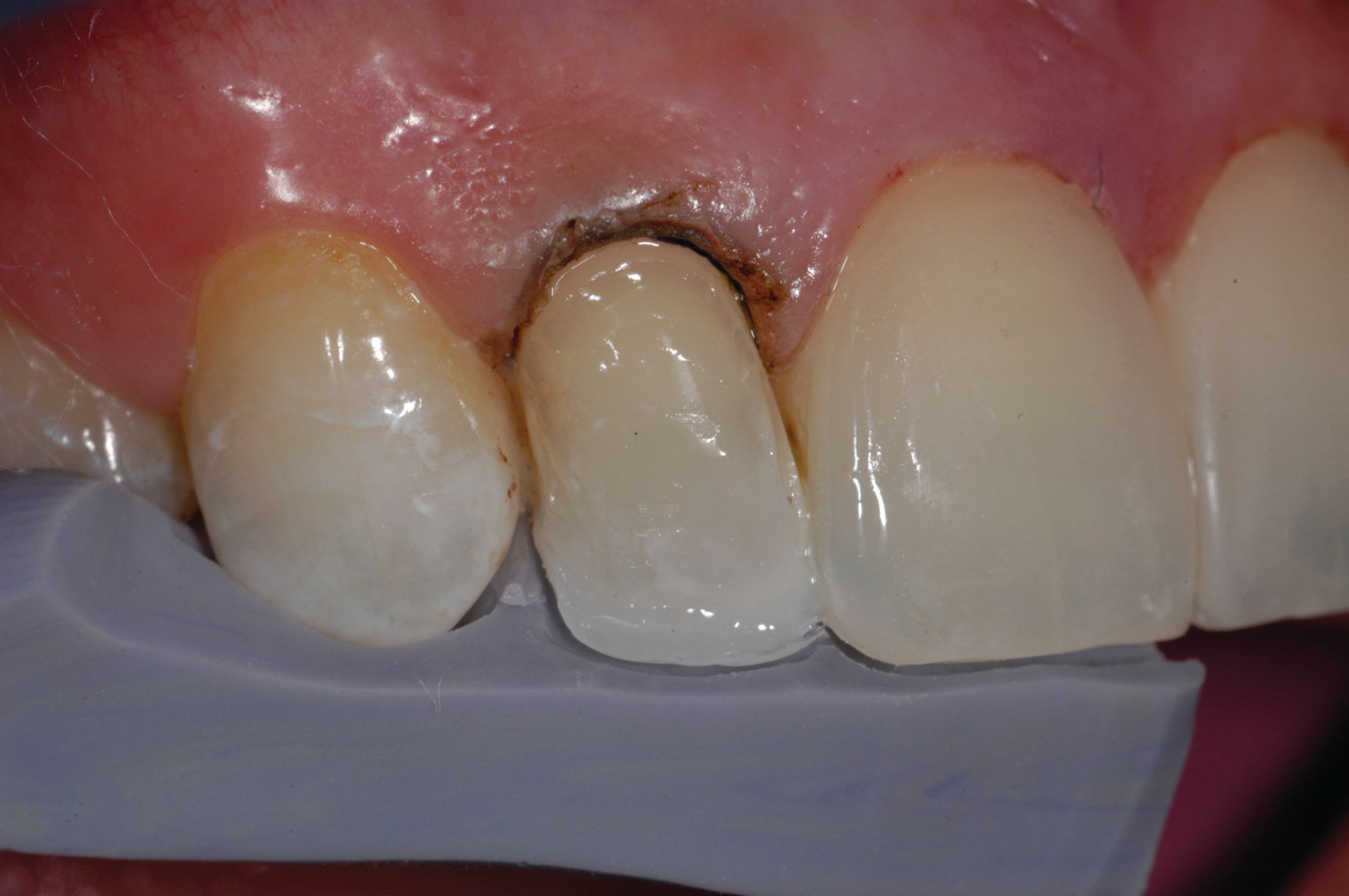 How to create conservative smile rejuvenation on a patient with peg ...