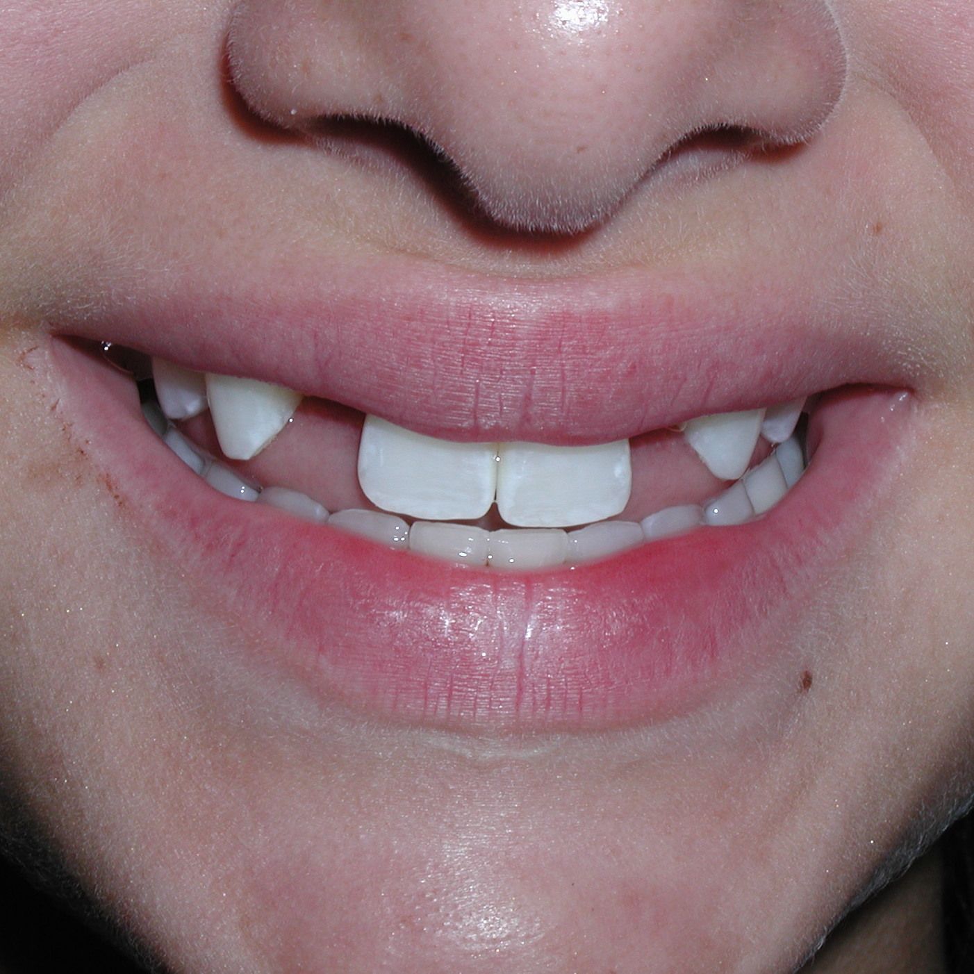 Understanding of Genetic Tooth Malformation Could Help Develop Future ...