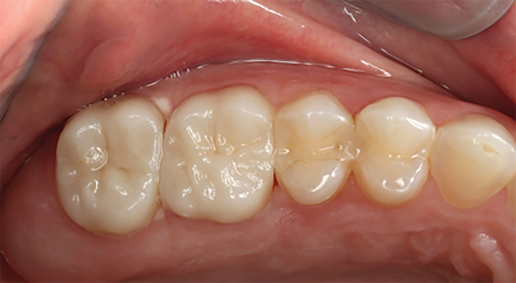 The Benchmark: One dental cement to rule them all