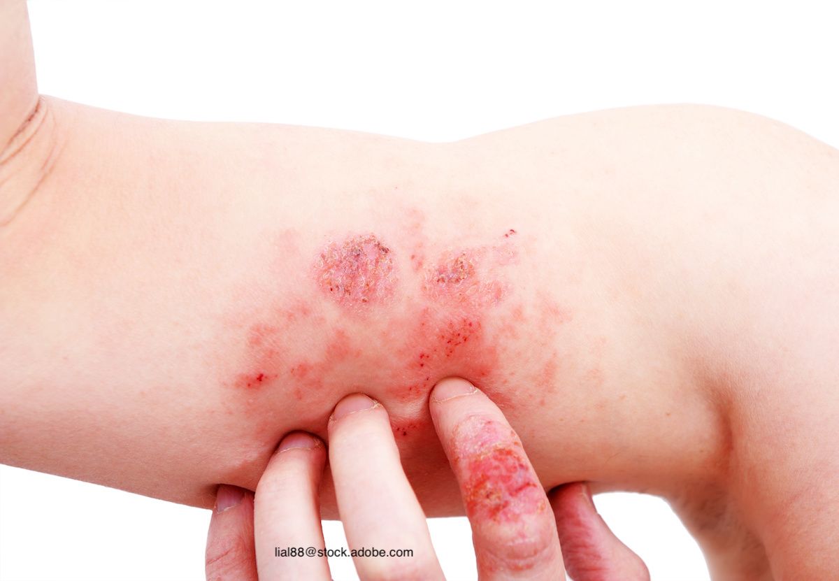 Dupixent Clinical Trial Results for Atopic Dermatitis Bolstered by Real ...