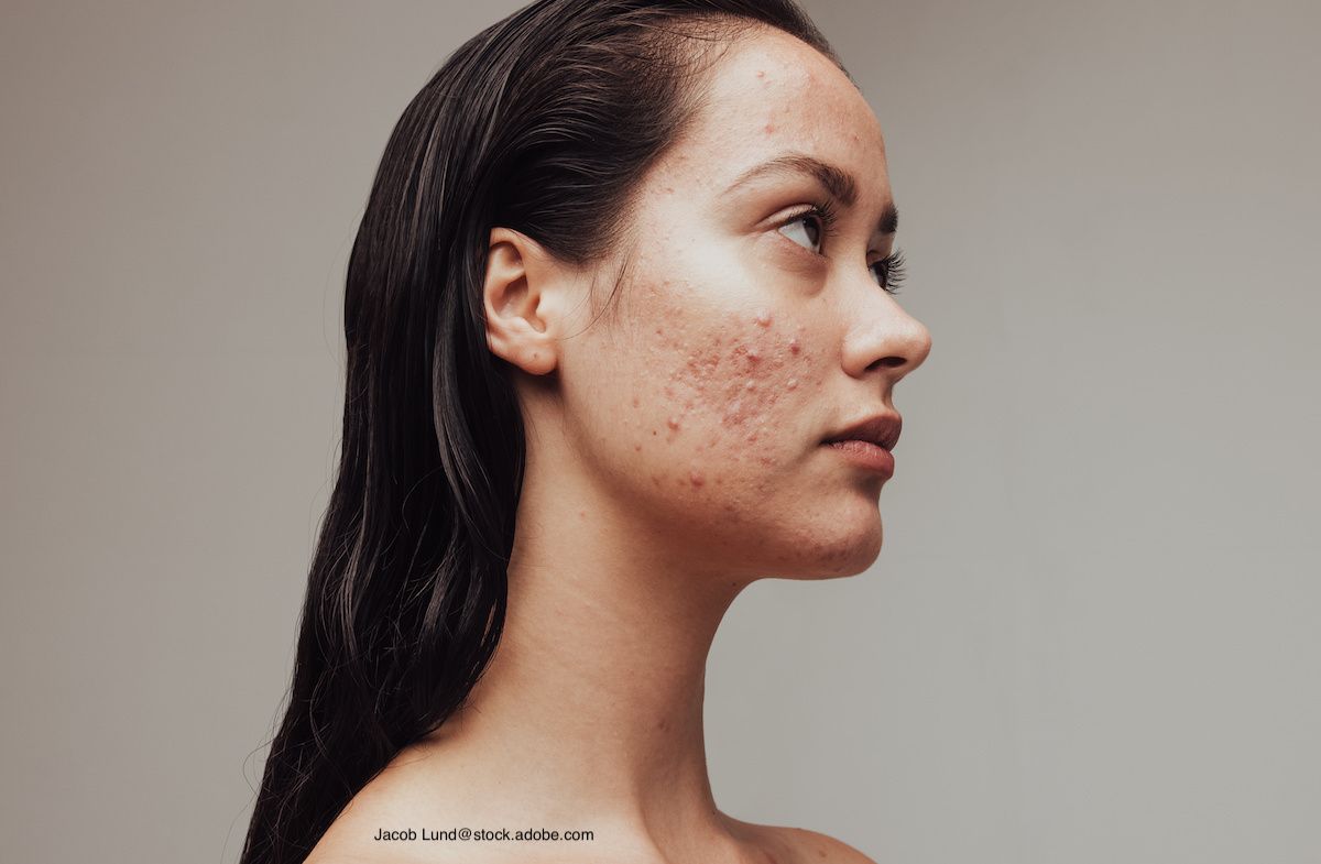 Latest Acne Treatment Pearls