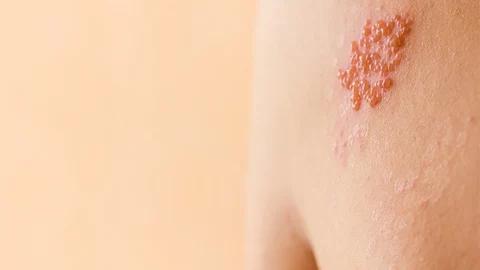 Raising Shingles Awareness With First-Ever Shingles Awareness Week ...